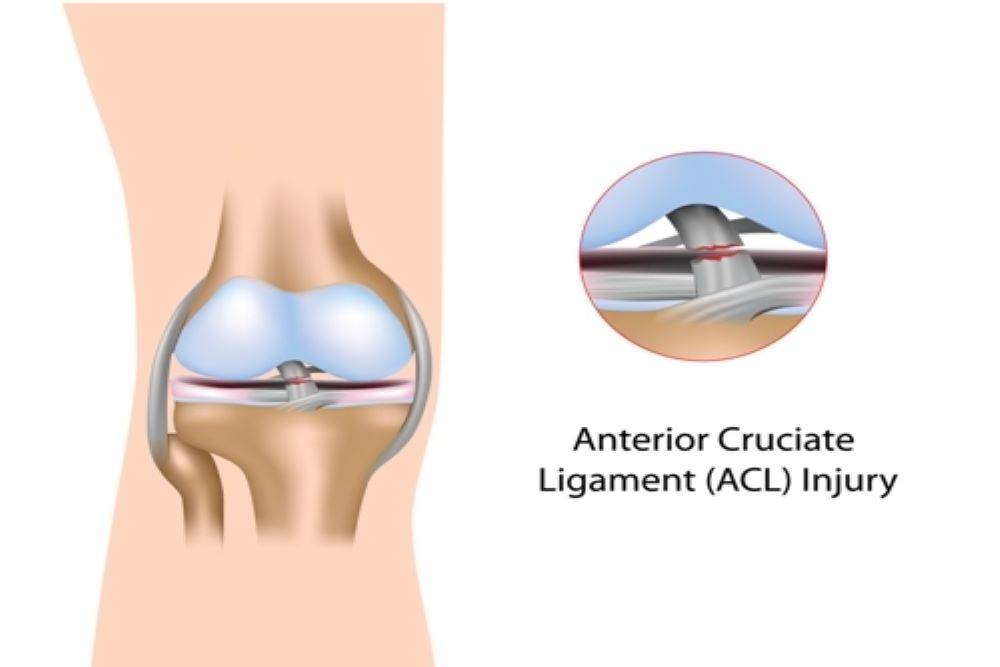 ACL Injury Shown And Explained Using 3D Medical Animation 57 OFF ACL Injury Shown And Explained Using 3D Medical Animation 57 OFF